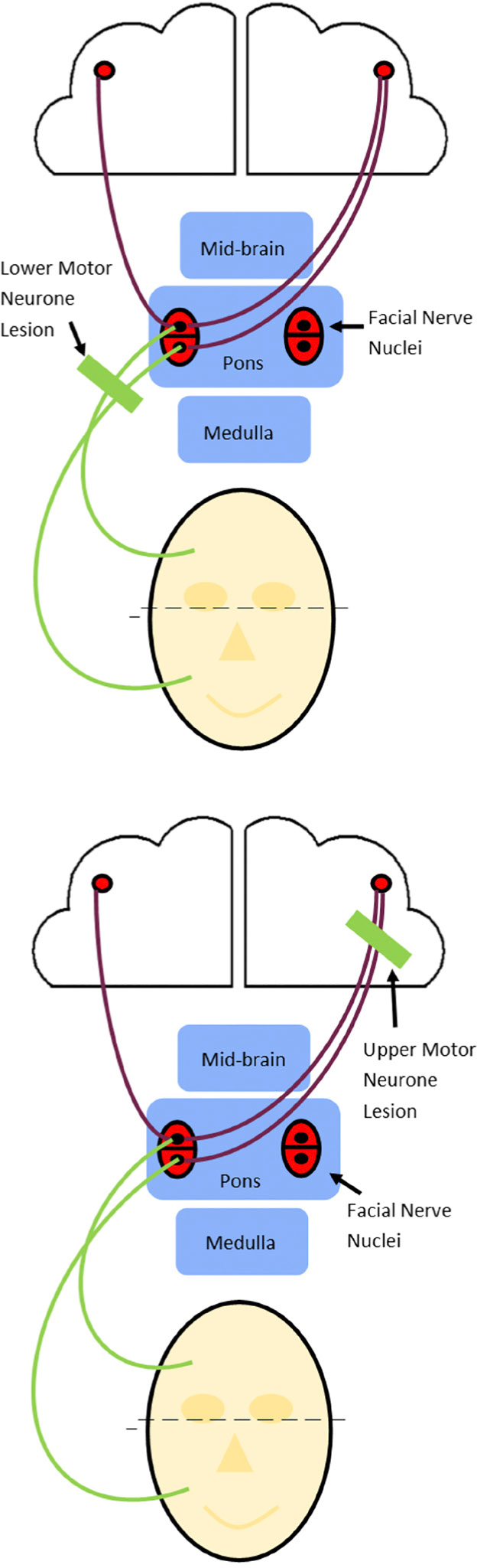 Facial Nerve Palsy Upper Motor Neuron Facial Nerve Palsy Upper Motor Neuron